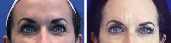 Why does my eyebrow droop after Botox? - Jason Cooper MD