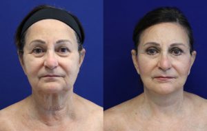 An Overview of Facelift Incision Lines and Scars - Jason Cooper MD